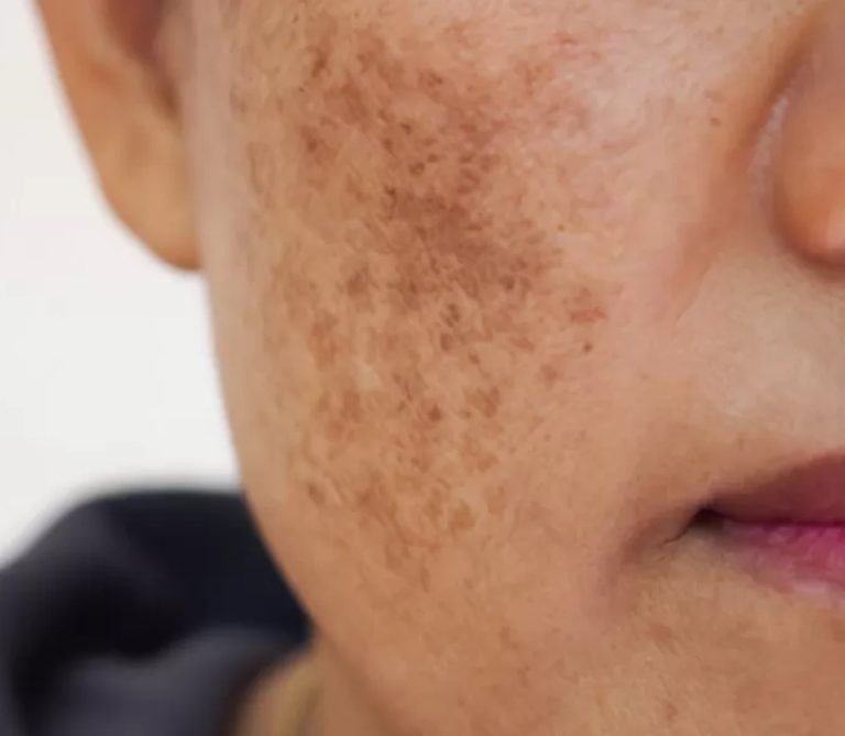 Pigmented Lesions Treatments | Eagan | Renew MedSpa