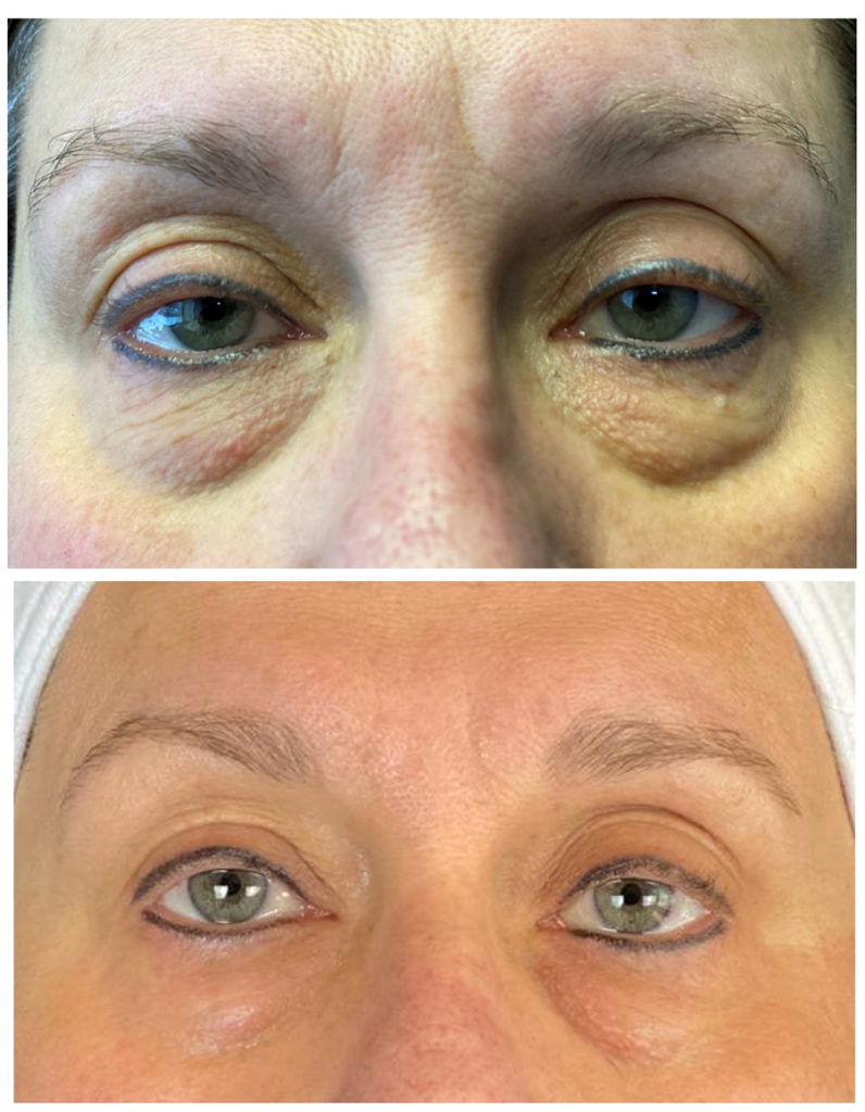 Plasma Pen Treatments | Eagan, MN | Renew MedSpa
