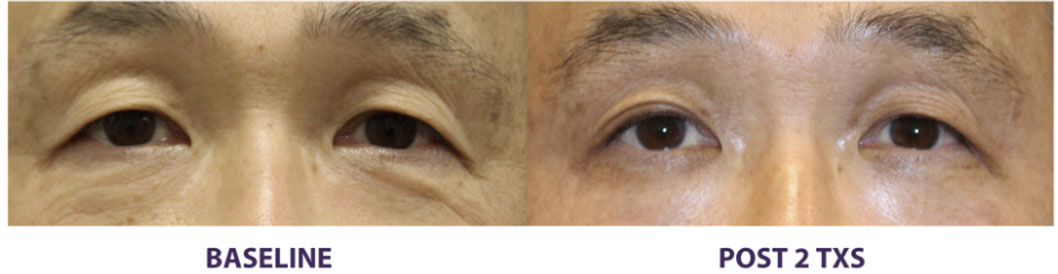 Opus Plasma | Renew MedSpa