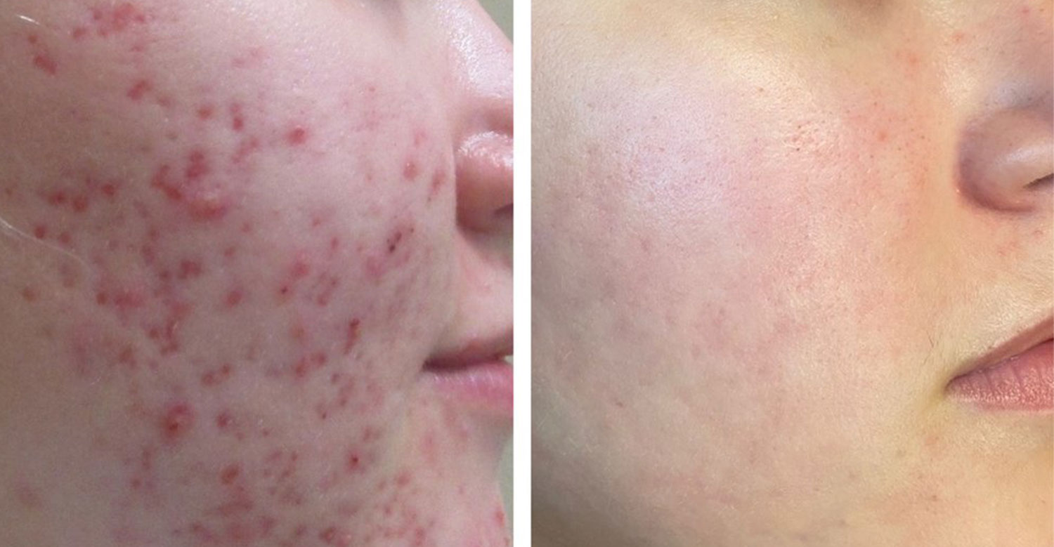 Microneedling | Renew MedSpa